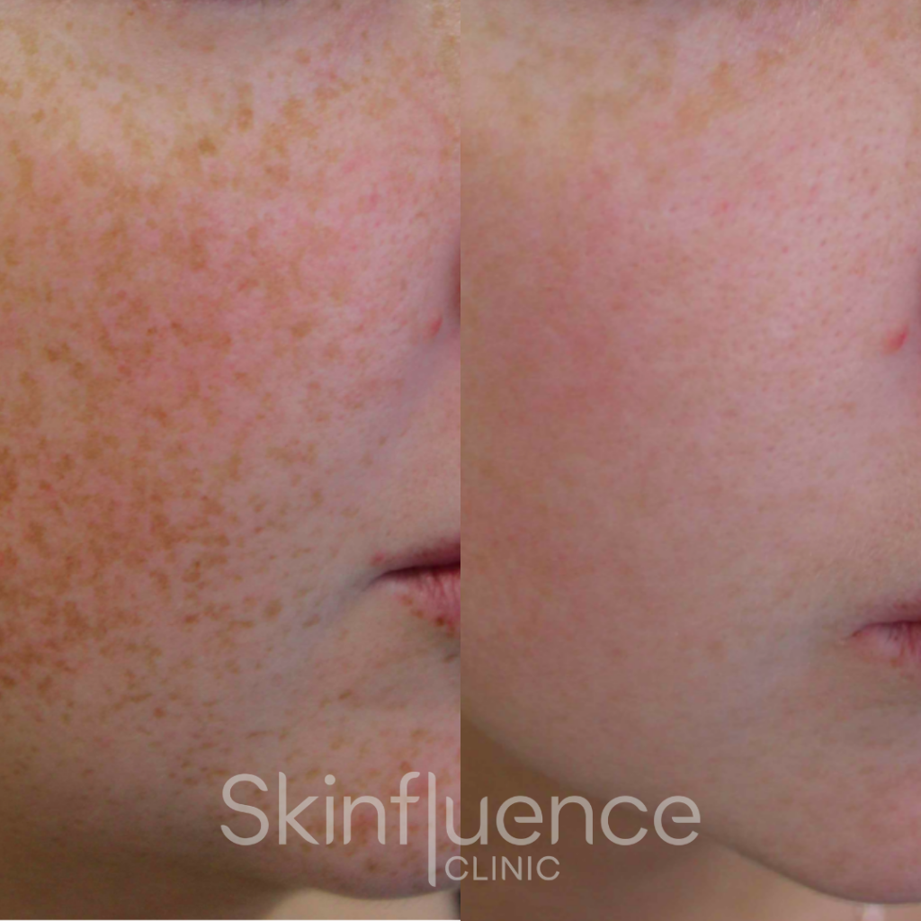 Pigmentation Gallery - Skinfluence Clinic